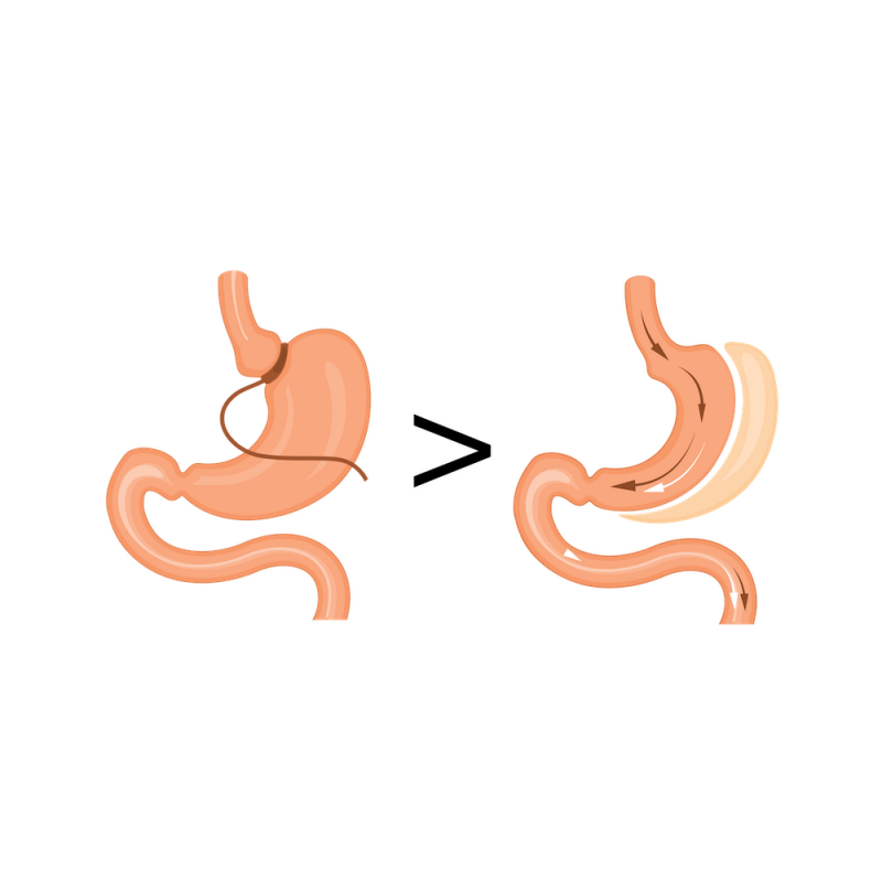 Bariatric Revision - Surgery Advisors